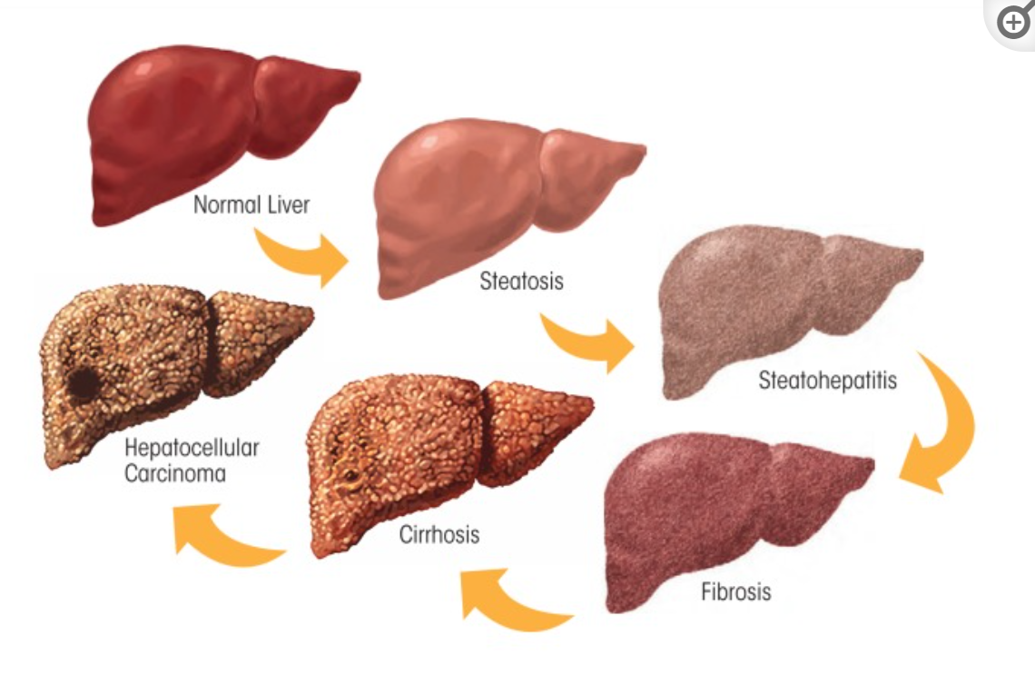 What Happens To Your Liver When You Stop Drinking?